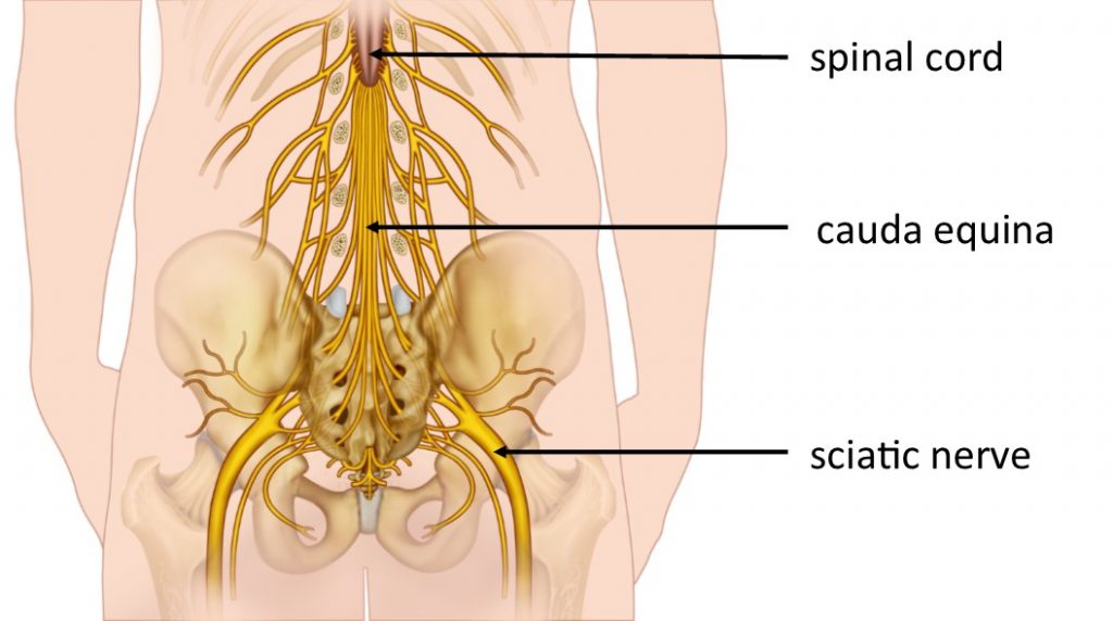 A patient's simple understanding of sciatica, radicular pain and radiculopathy - Living Well ...