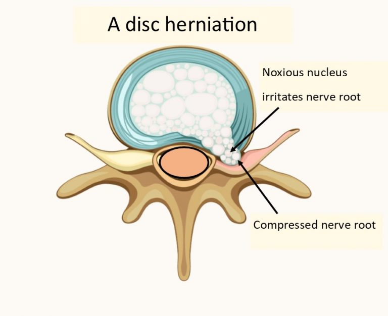 A patient's simple understanding of sciatica, radicular pain and ...