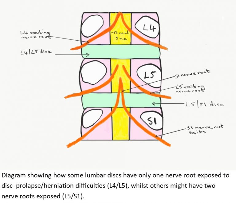 A patient's simple understanding of sciatica, radicular pain and ...