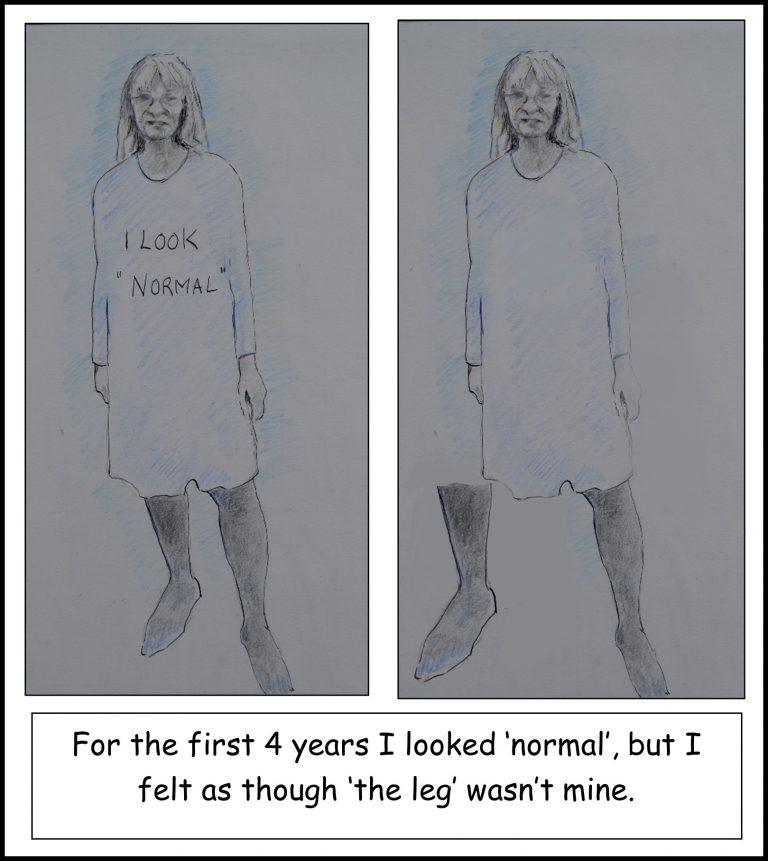 'My' leg isn't mine! - Living Well with Pain