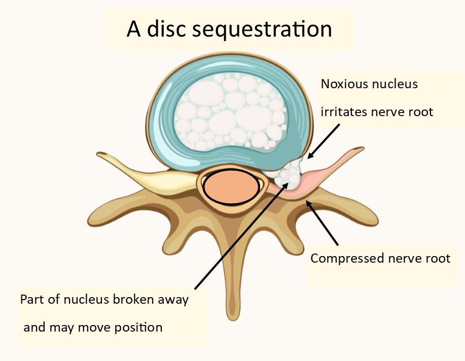 A patient's simple understanding of sciatica, radicular pain and ...
