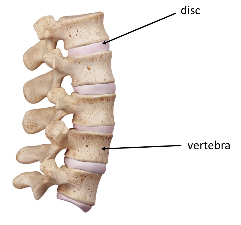 A patient's simple understanding of sciatica, radicular pain and ...